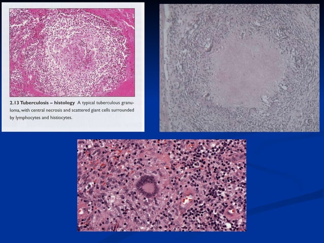 Osteo articular tuberculosis -1 | PPT