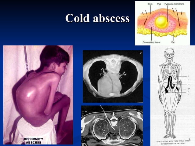 Osteo articular tuberculosis -1 | PPT