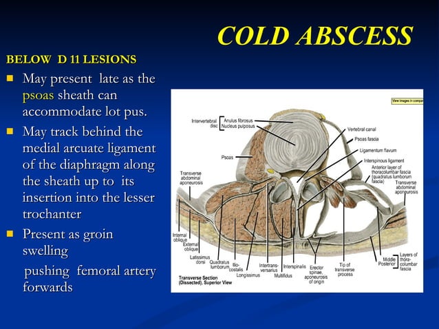 Osteo articular tuberculosis -1 | PPT