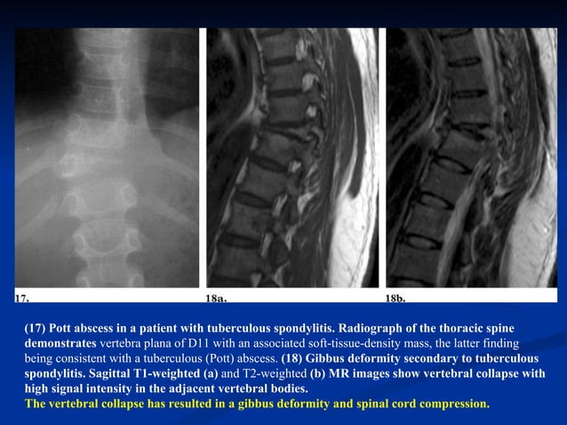 Osteo articular tuberculosis -1 | PPT