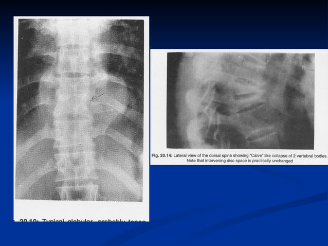 Osteo articular tuberculosis -1 | PPT