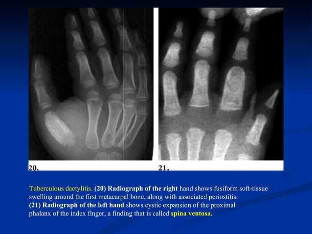 Osteo articular tuberculosis -1 | PPT