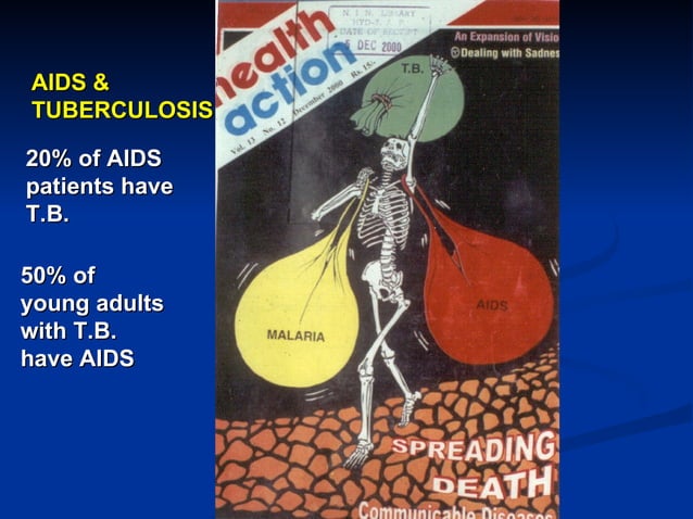 Osteo articular tuberculosis -1 | PPT