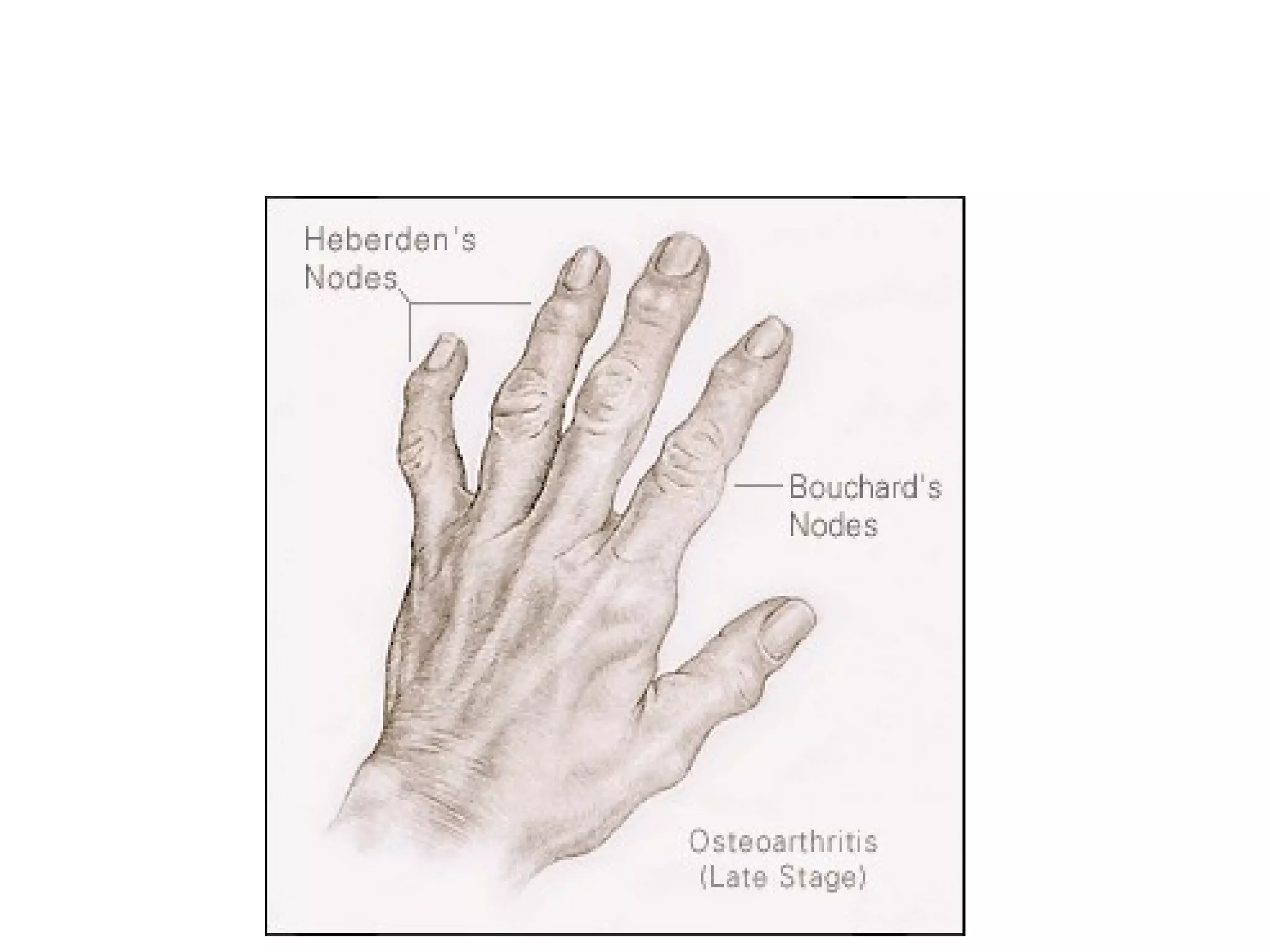 Osteoarth & Rheumatoid arthritis | PPT