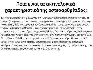 Οστεοαρθρίτιδα | PPT