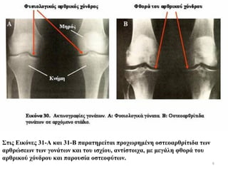 Οστεοαρθρίτιδα | PPT