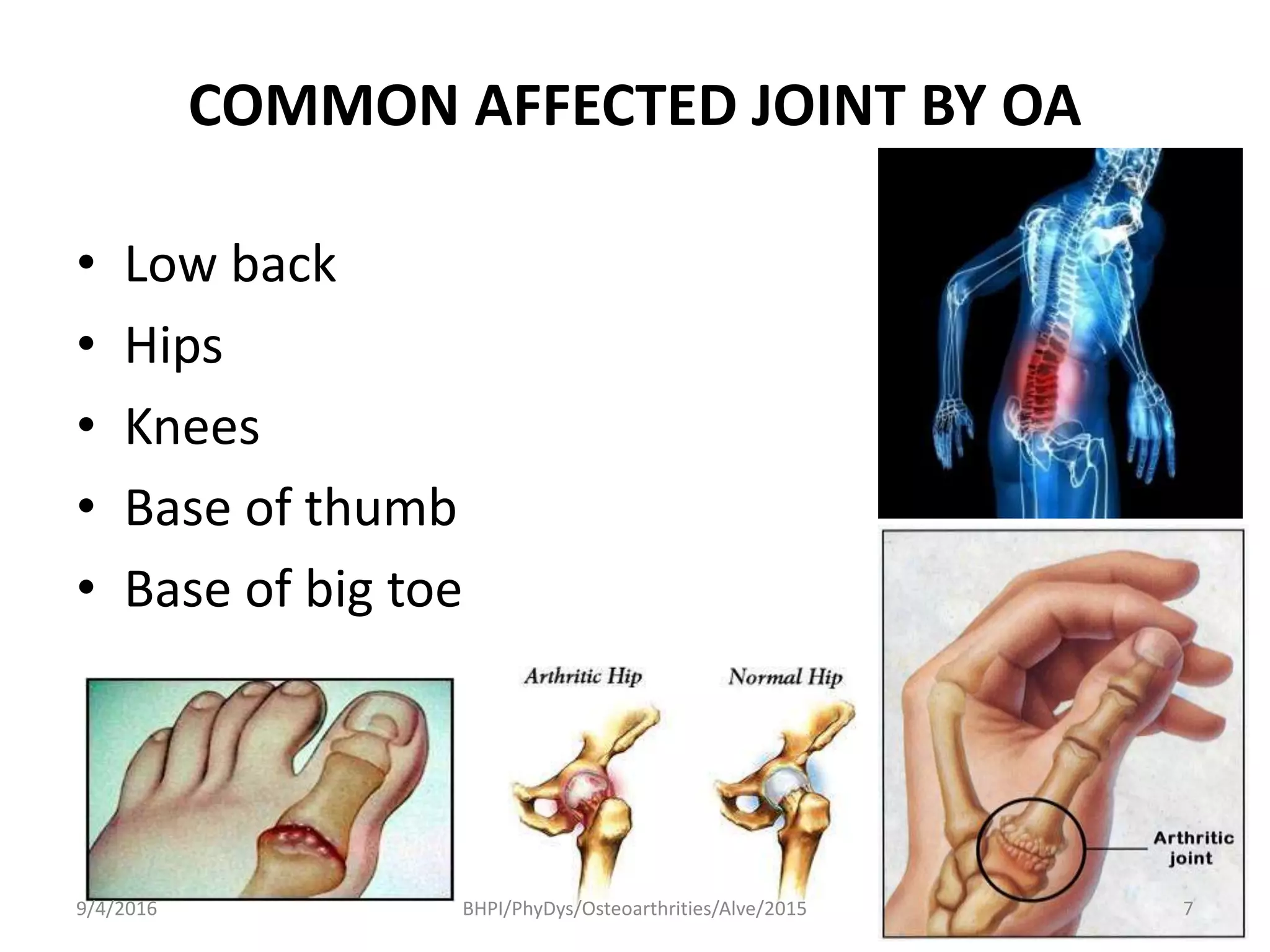 Occupational Therapy for Osteoarthrities | PPTX