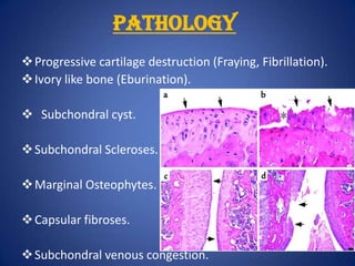 orthopedics.Osteoarthritis.(dr.ariwan) | PPTX