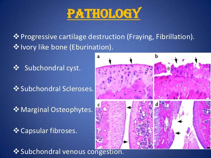 orthopedics.Osteoarthritis.(dr.ariwan)