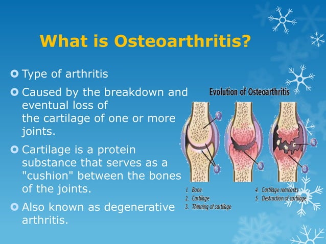 Osteoarthritis | PPTX