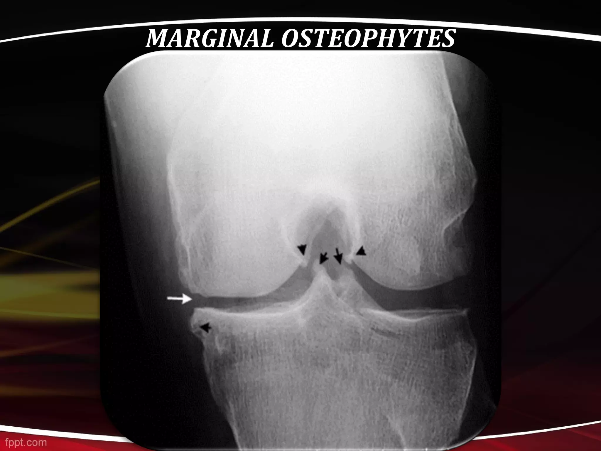 Osteoarthritis | PPT