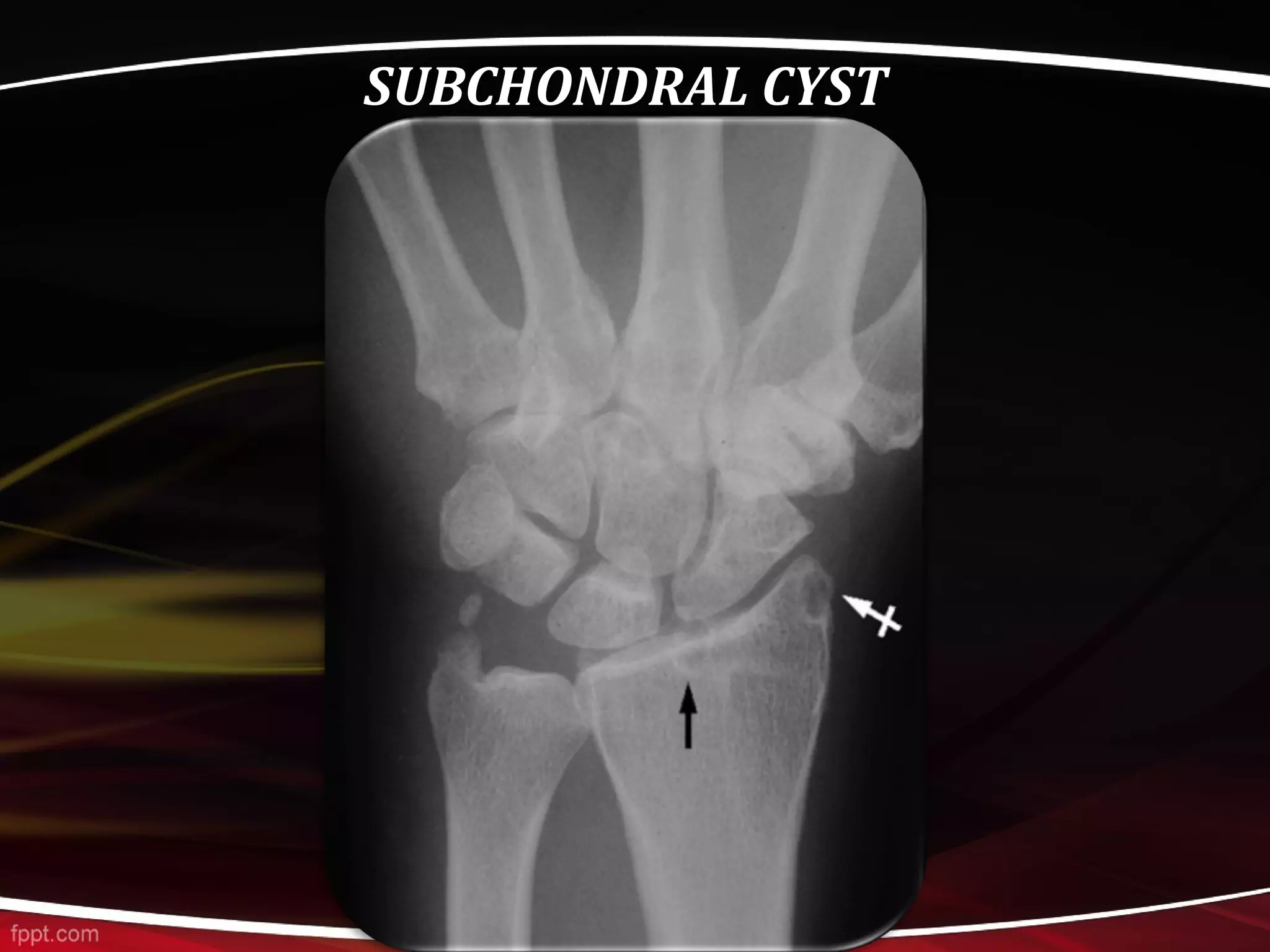 Osteoarthritis | PPT
