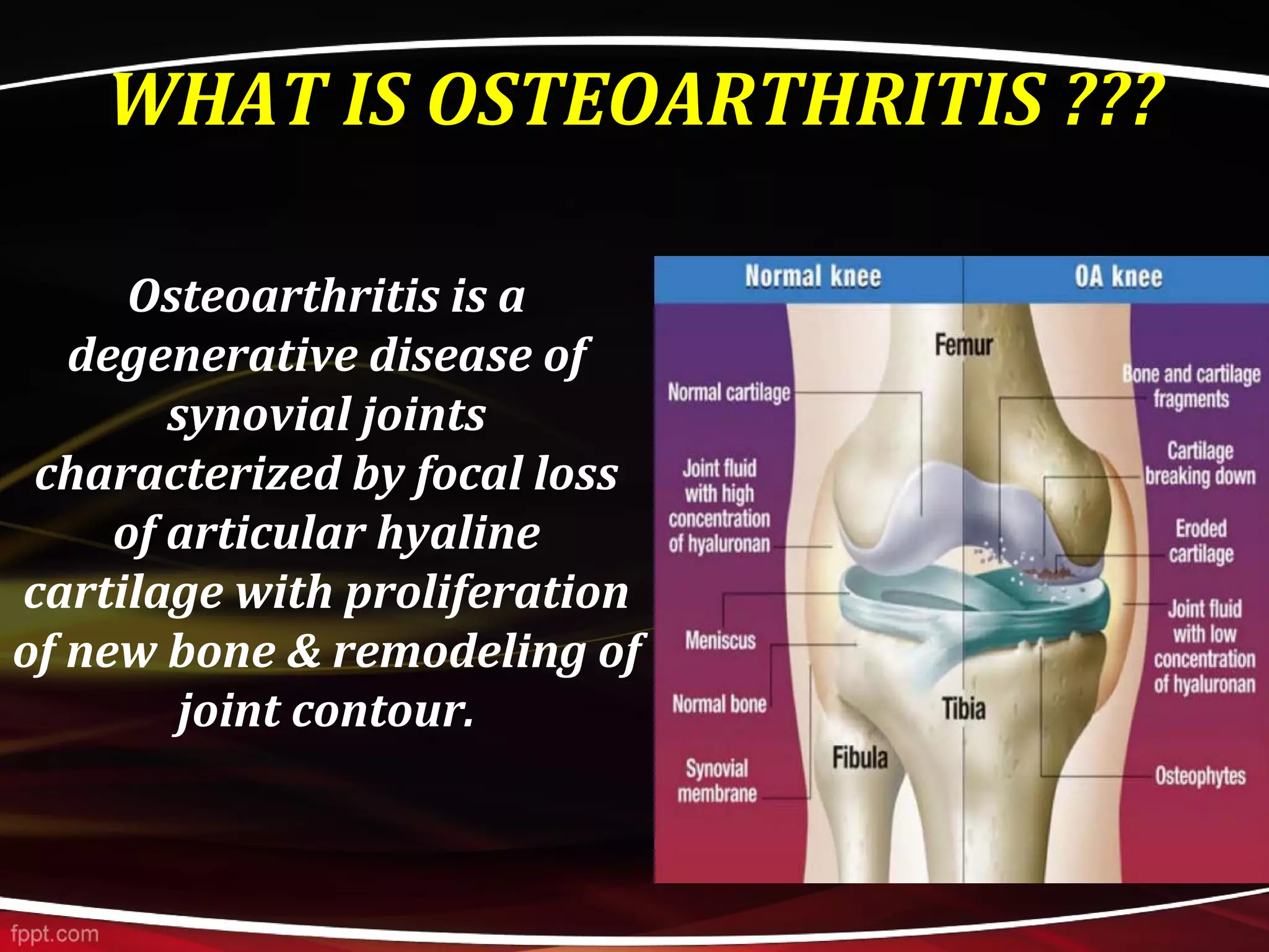 Osteoarthritis Ppt