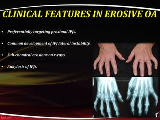 Osteoarthritis | PPT