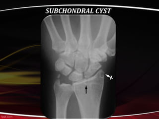 Osteoarthritis | PPT