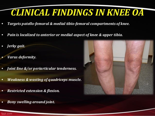 Osteoarthritis & Surgery - Max Superspecialty Ortho Clinic