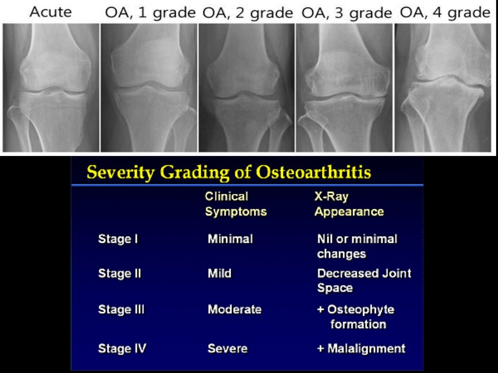 Osteoarthritis