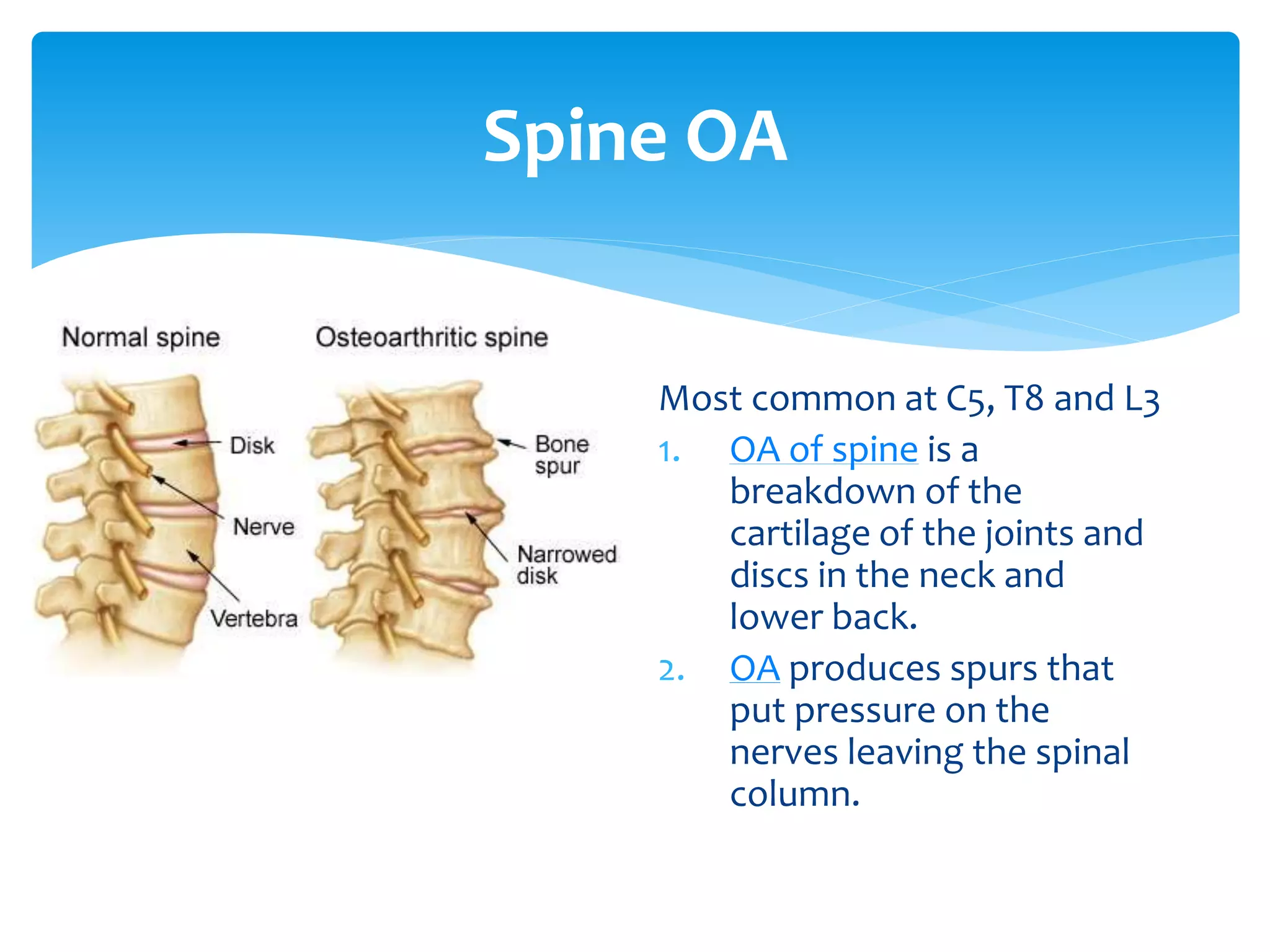 Osteoarthritis | PPTX