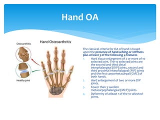 Osteoarthritis | PPTX