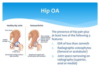 Osteoarthritis | PPTX