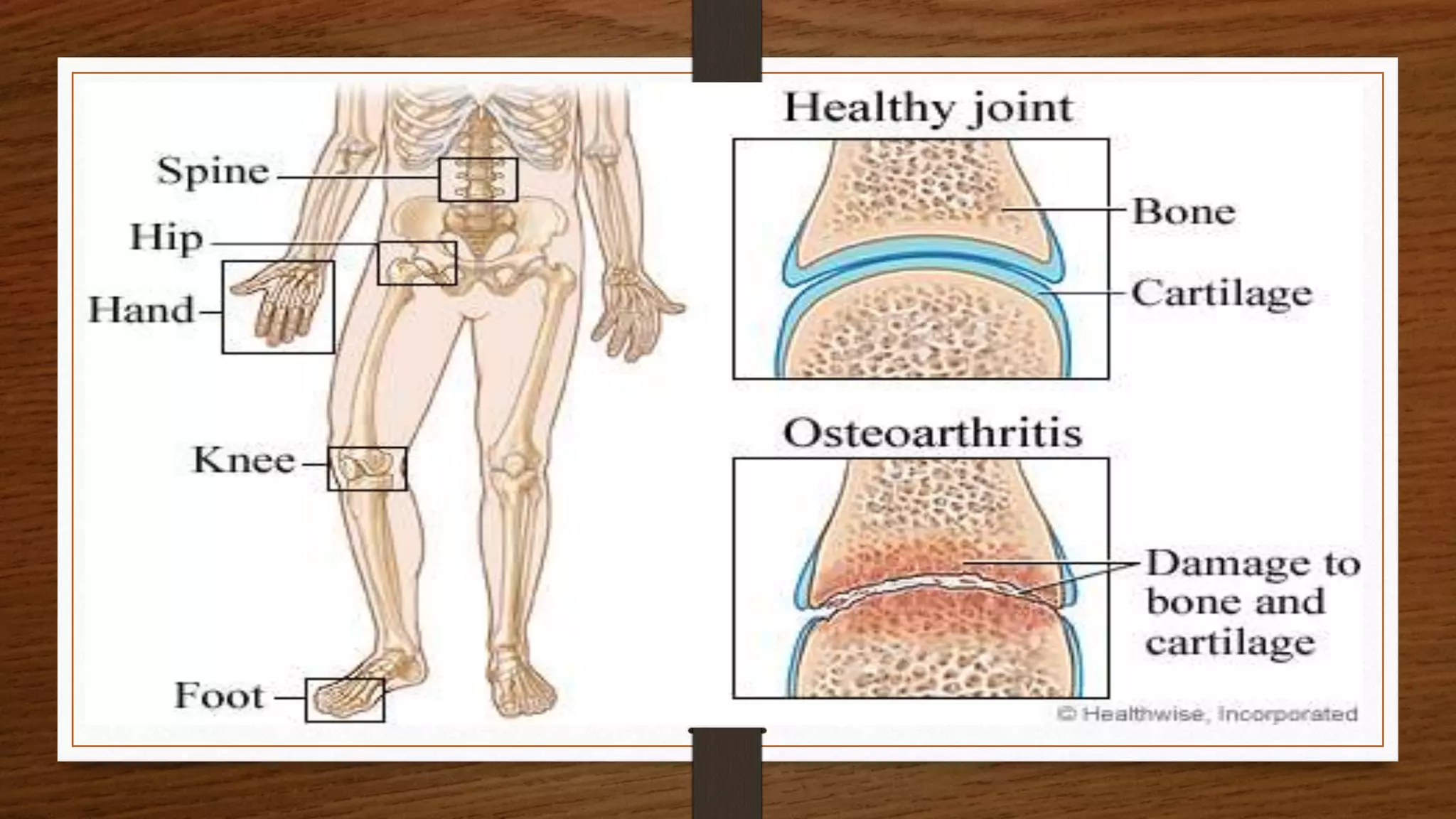 Osteoarthritis | PPTX
