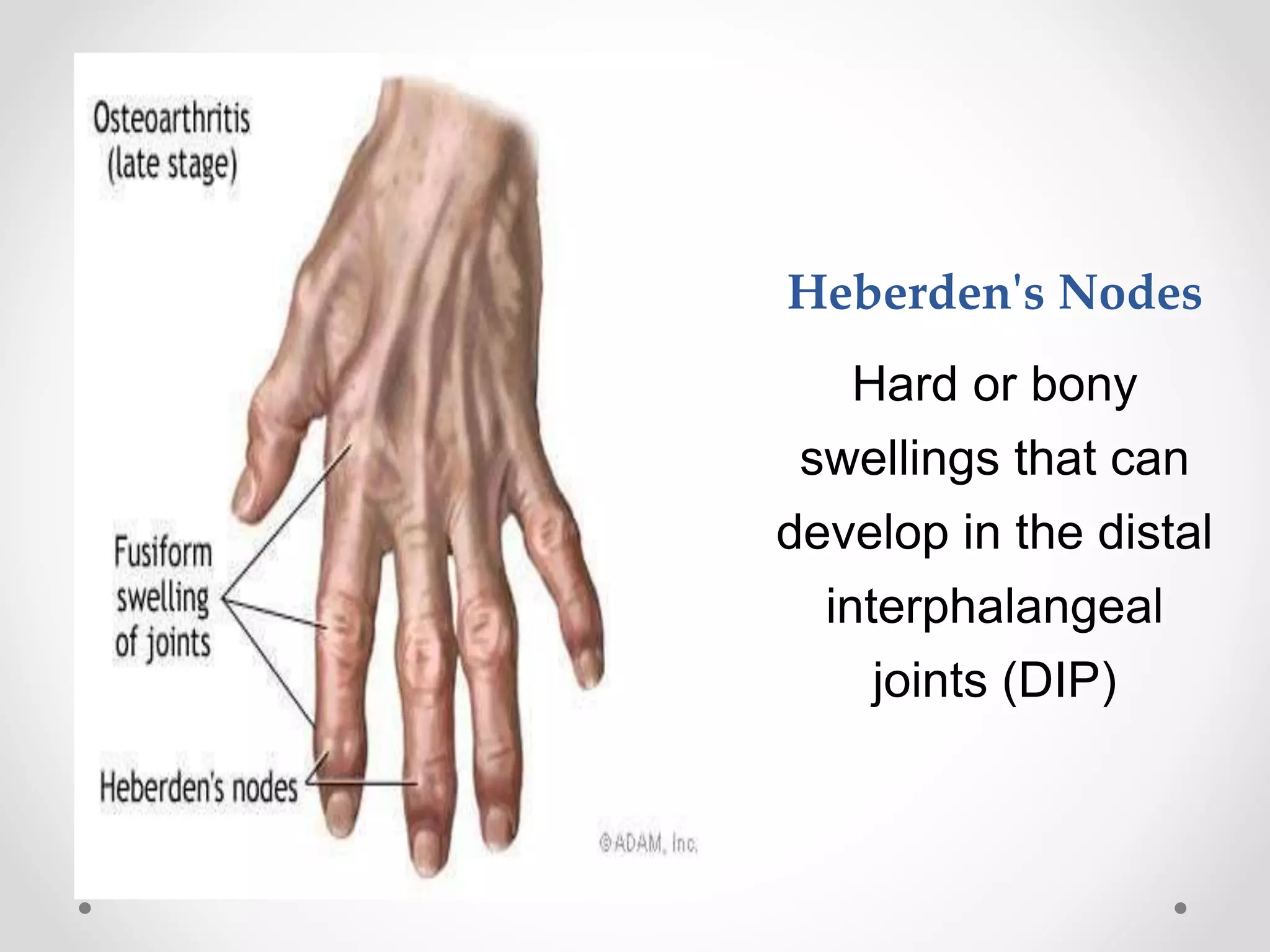 Osteoarthritis | PPTX