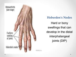 Osteoarthritis | PPTX