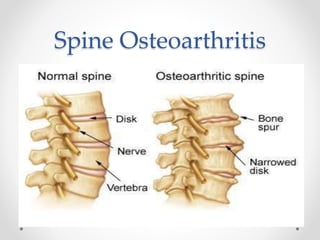 Osteoarthritis | PPTX