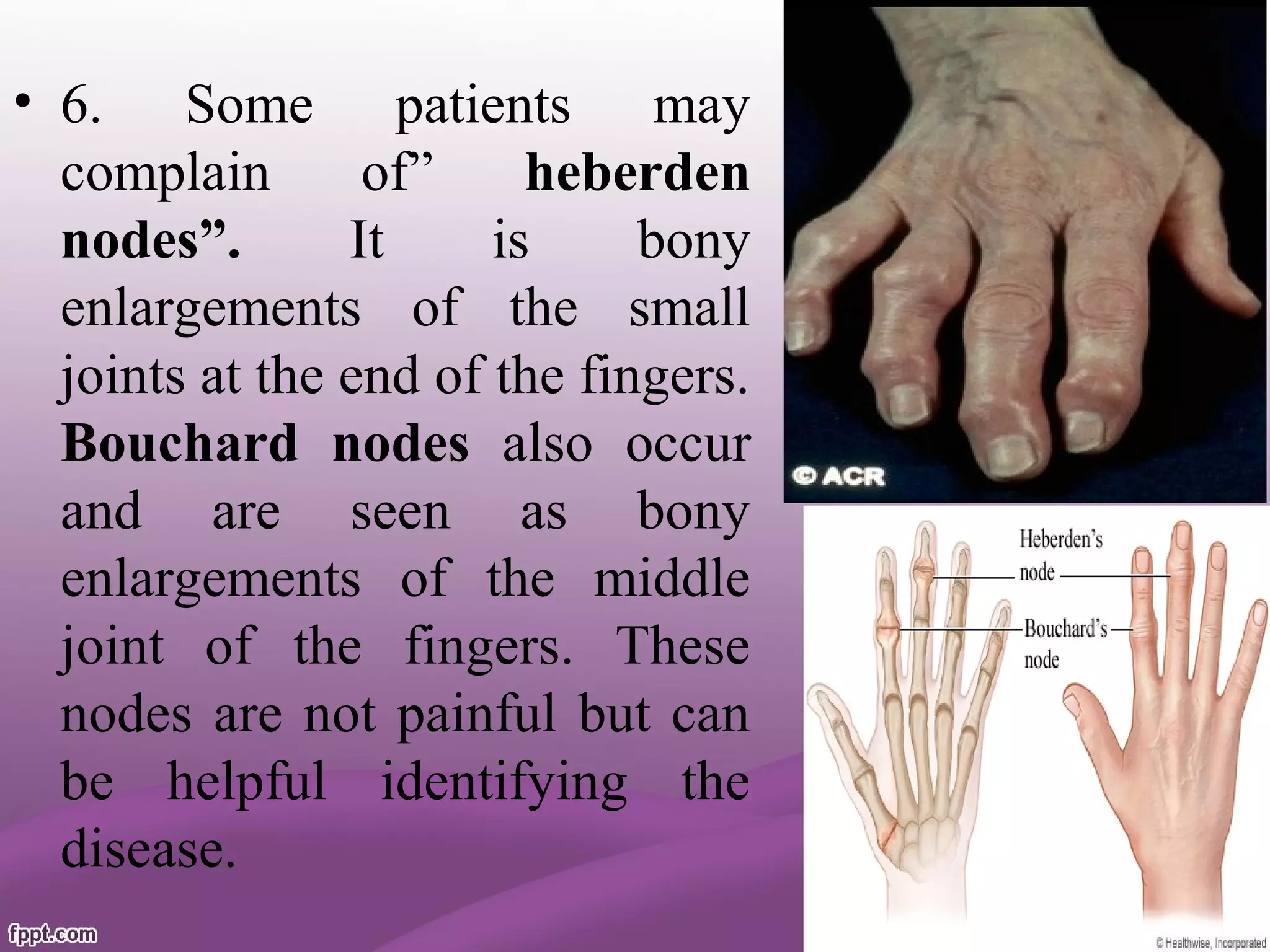Osteoarthritis | PPT