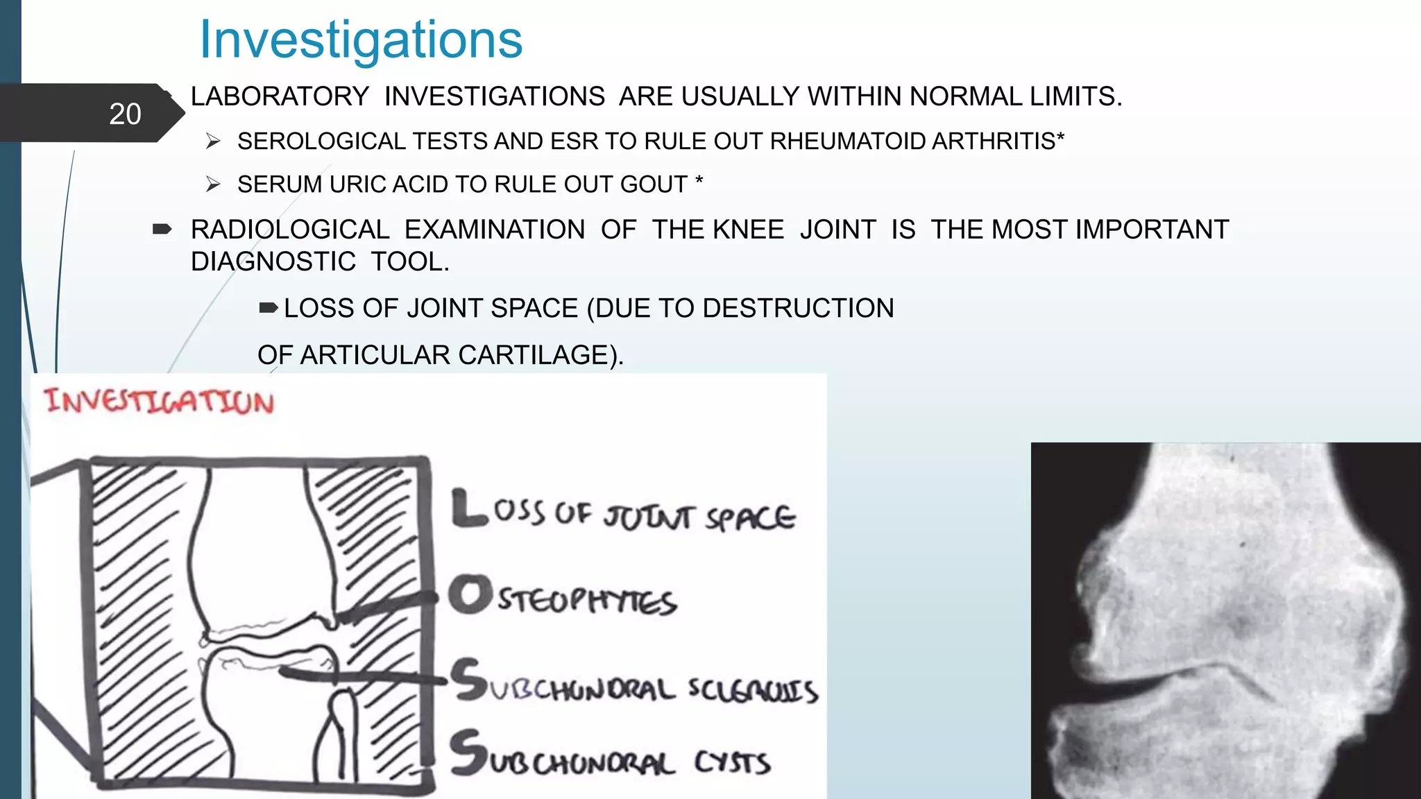 Knee joint Osteoarthritis | PPTX