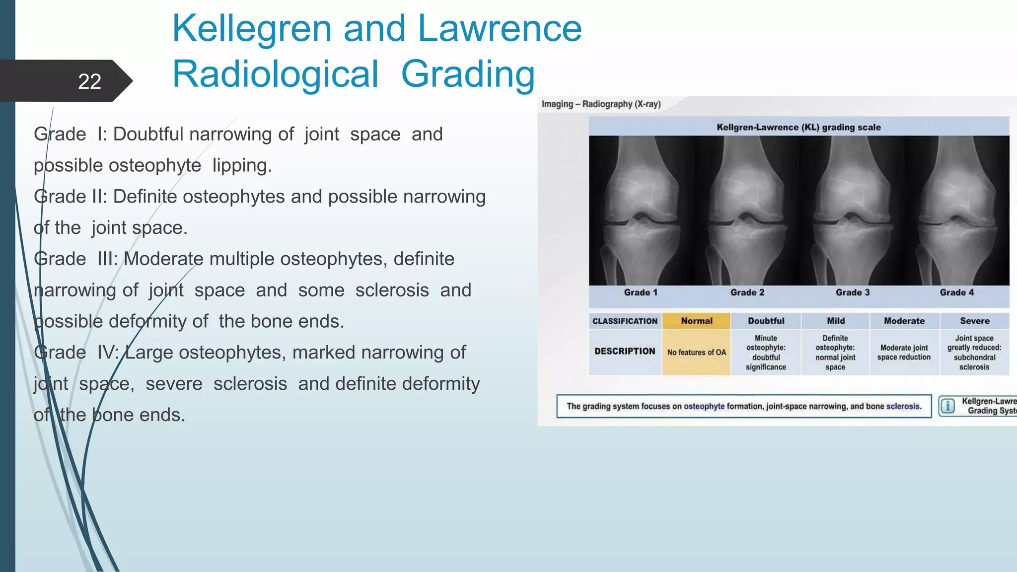 Knee joint Osteoarthritis | PPTX