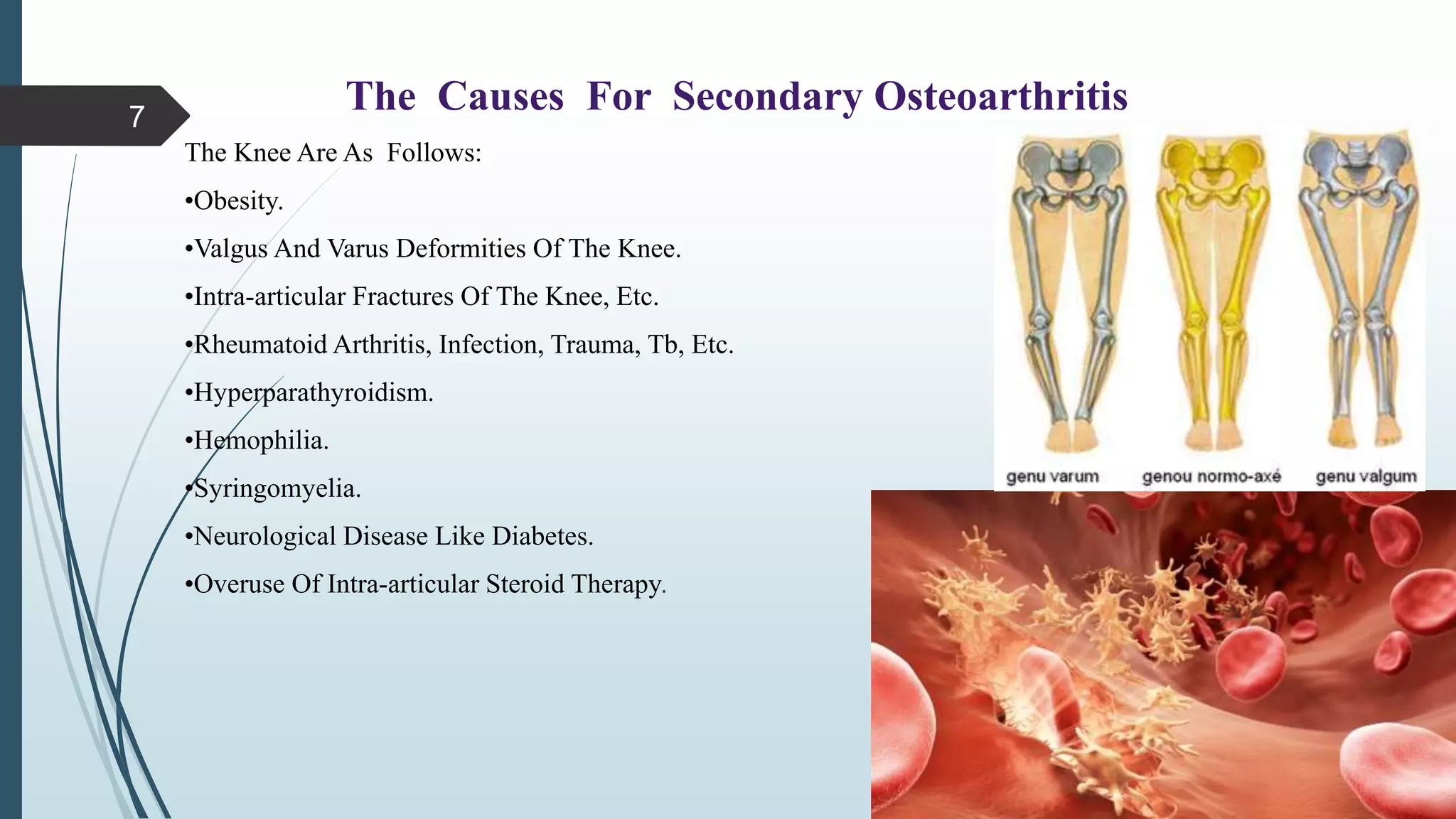 Knee joint Osteoarthritis | PPTX