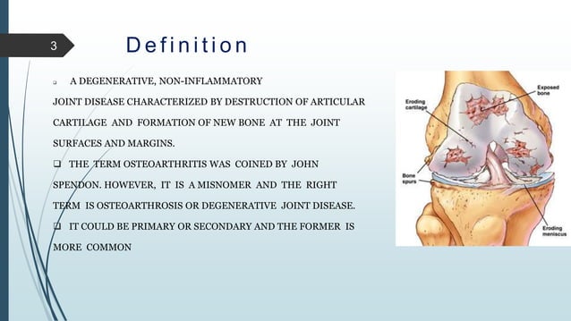 Knee Joint Osteoarthritis Pptx