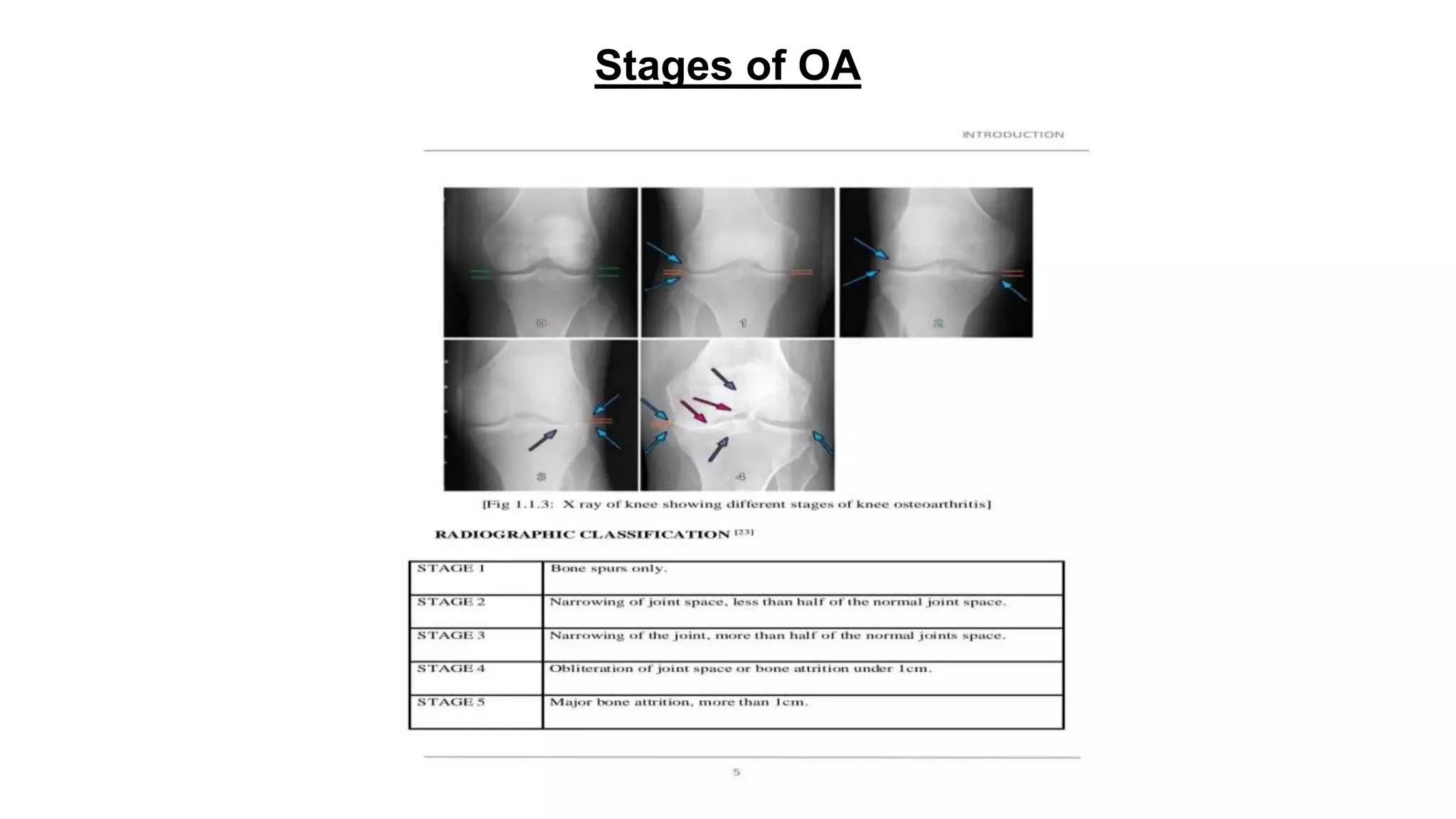 Osteoarthritis by Dr. K. A Rana -2.pptx