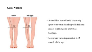 Osteoarthritis by Dr. K. A Rana -2.pptx