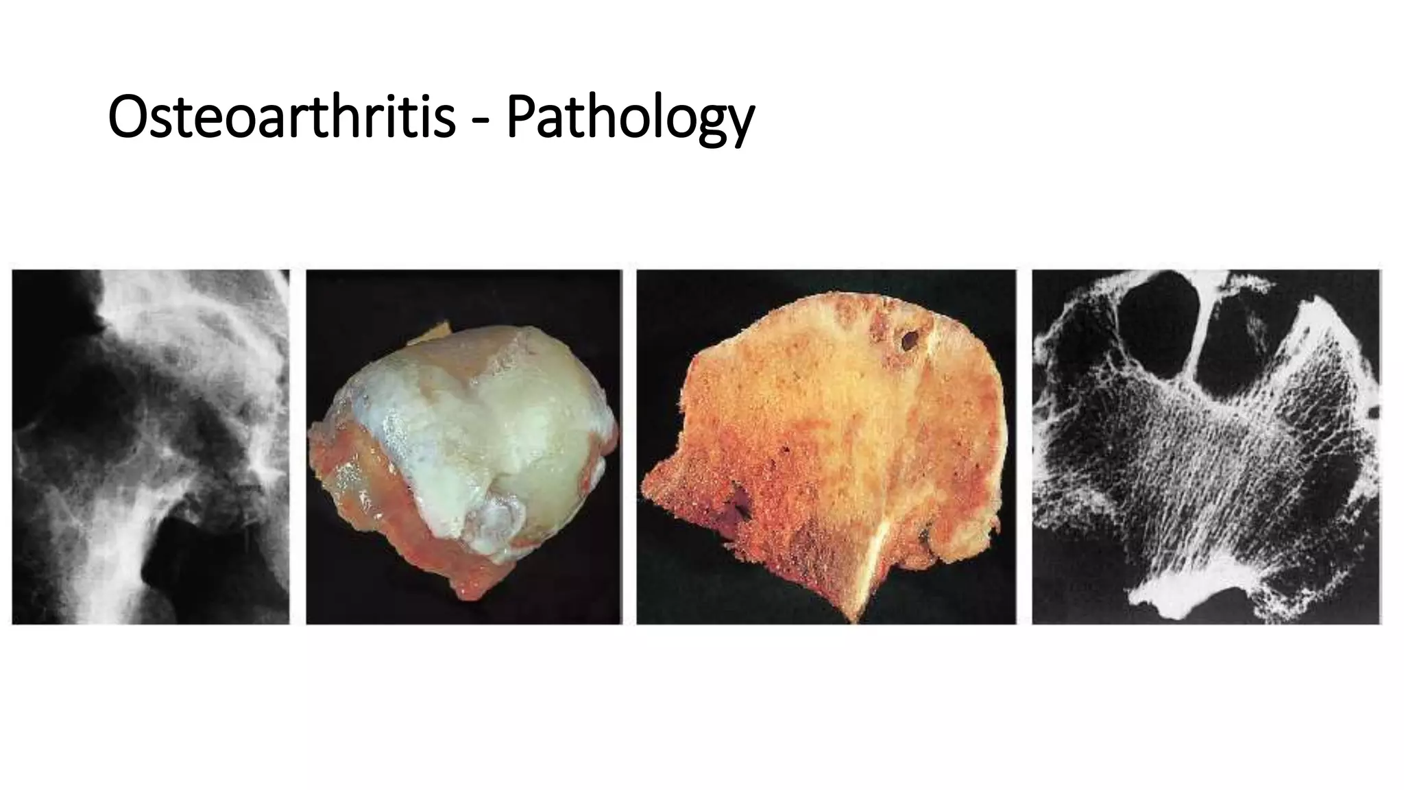 Osteoarthritis | PPTX