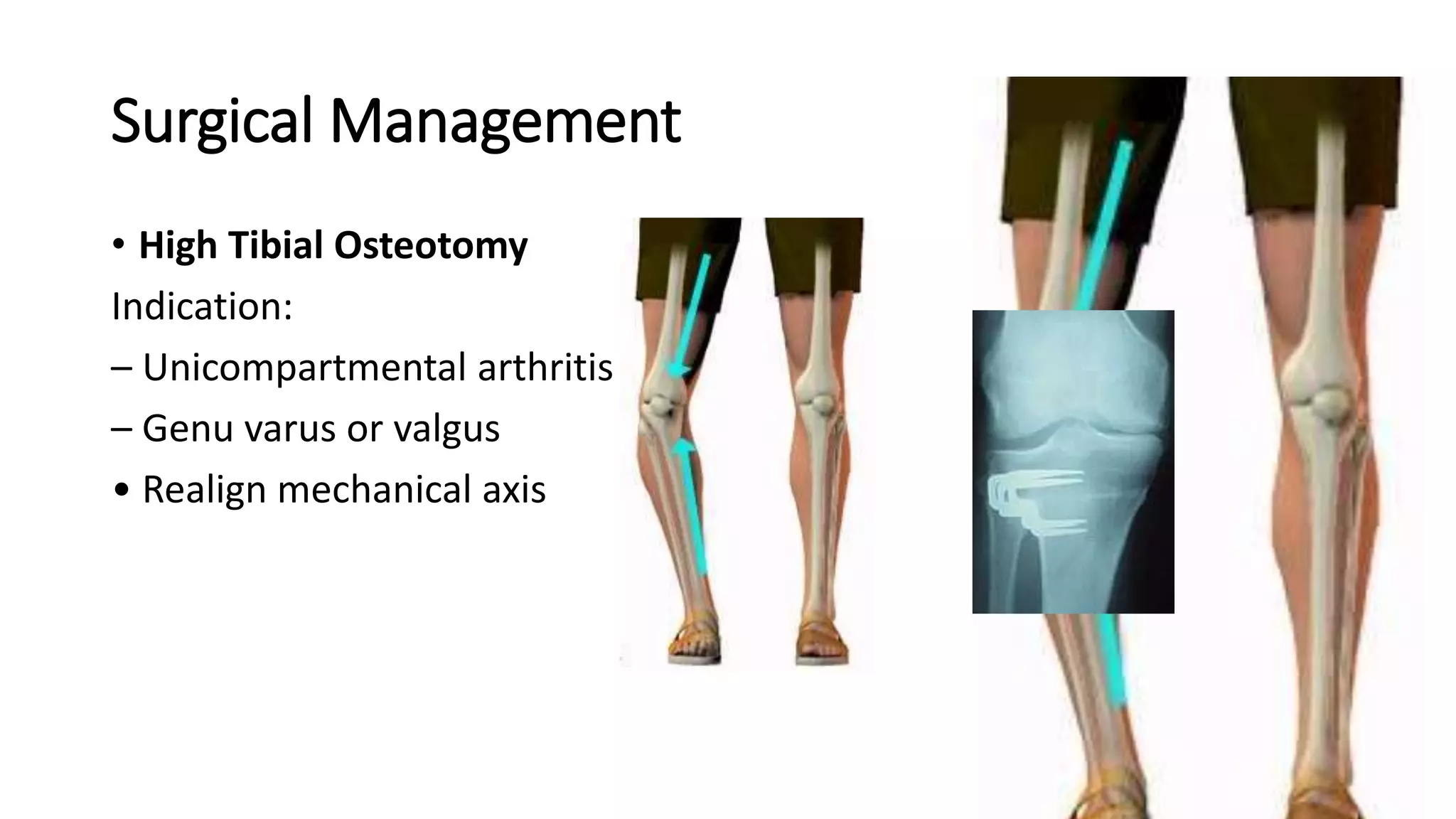 Osteoarthritis | PPTX
