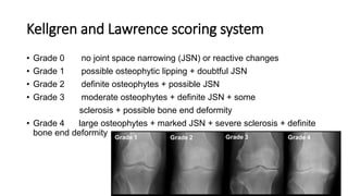 Osteoarthritis | PPTX