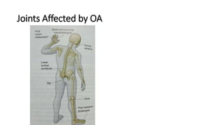 Osteoarthritis | PPTX | Physical Therapy | Wellness
