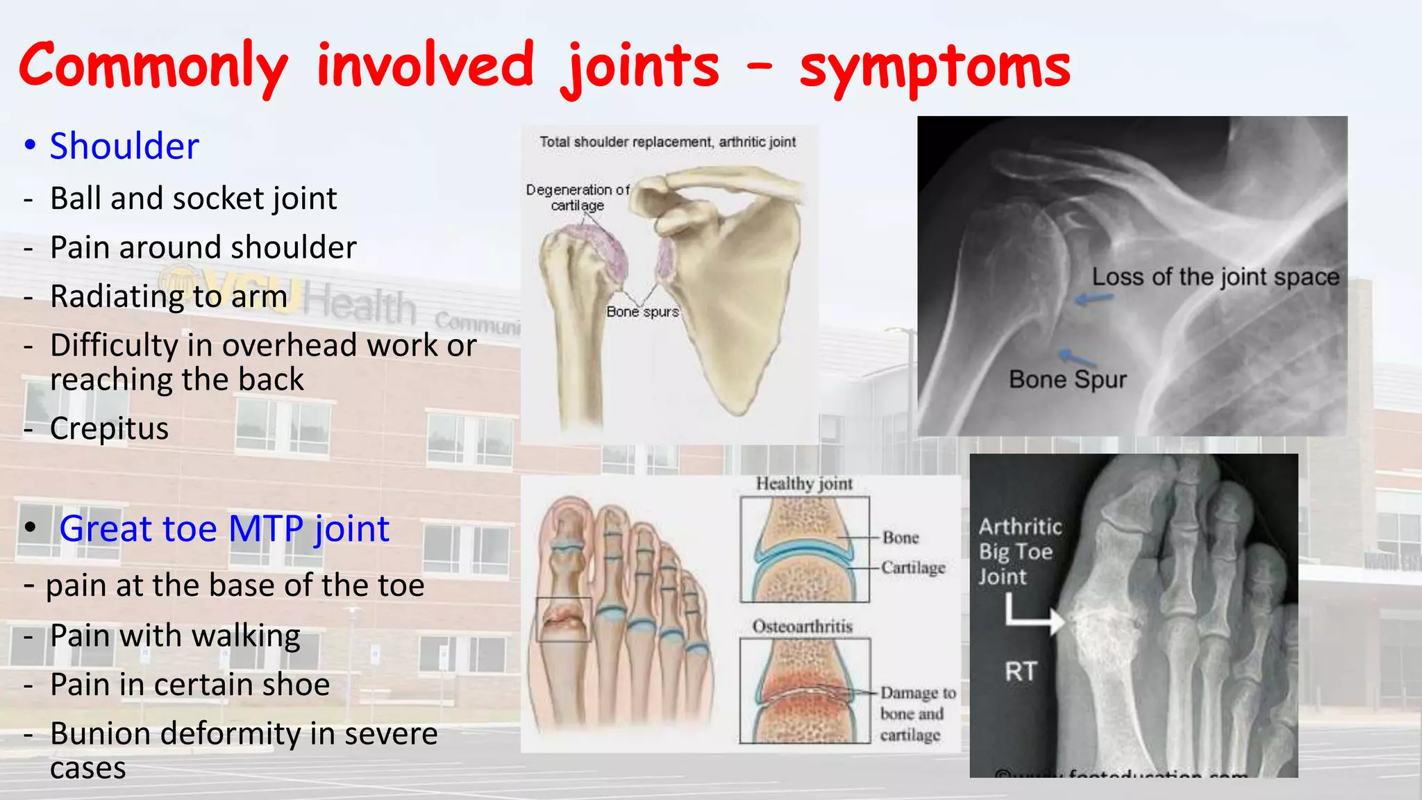 Osteoarthritis of joints and related treatment | PPTX