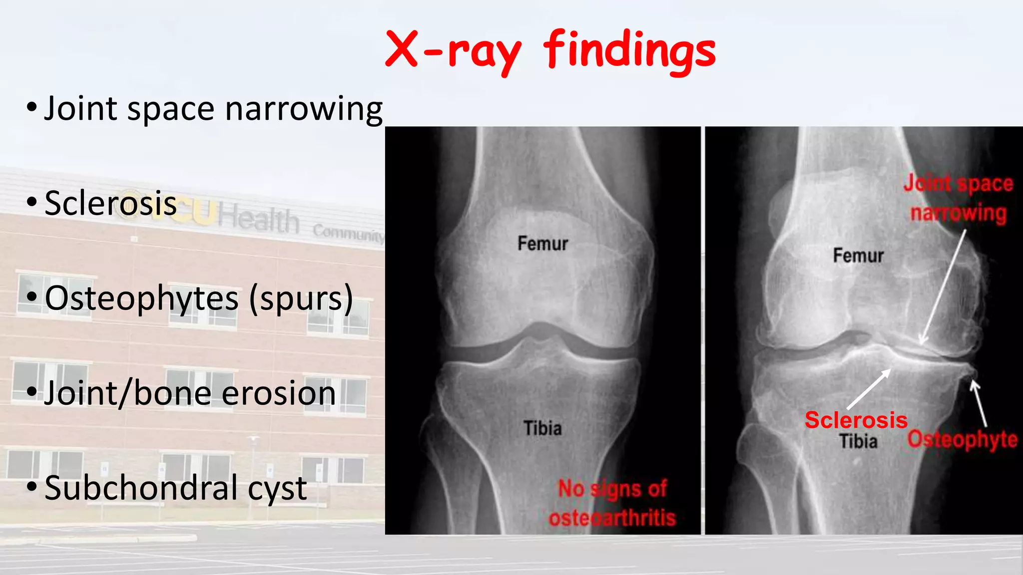 Osteoarthritis of joints and related treatment | PPTX