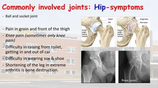 Osteoarthritis of joints and related treatment | PPTX