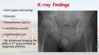 Osteoarthritis of joints and related treatment | PPTX