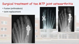 Osteoarthritis of joints and related treatment | PPTX