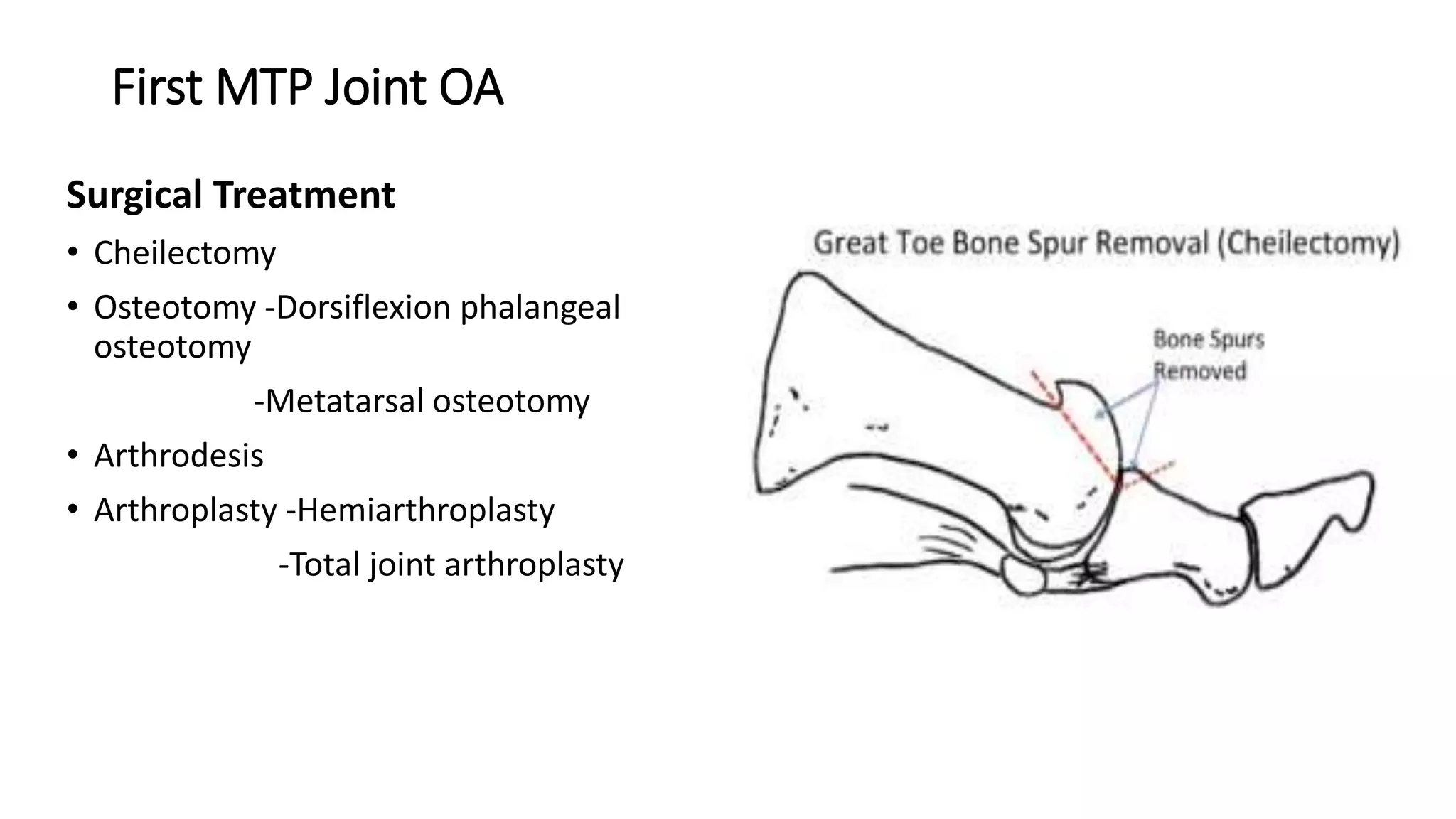 Osteoarthritis slideshare | PPTX