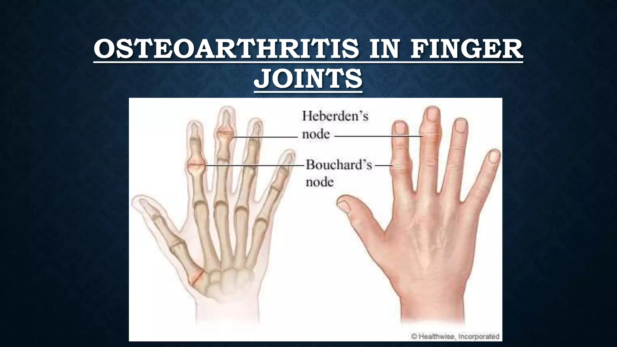 Osteoarthritis in Nursing studies | PPTX