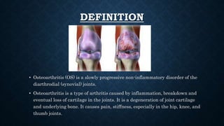 Osteoarthritis in Nursing studies | PPTX