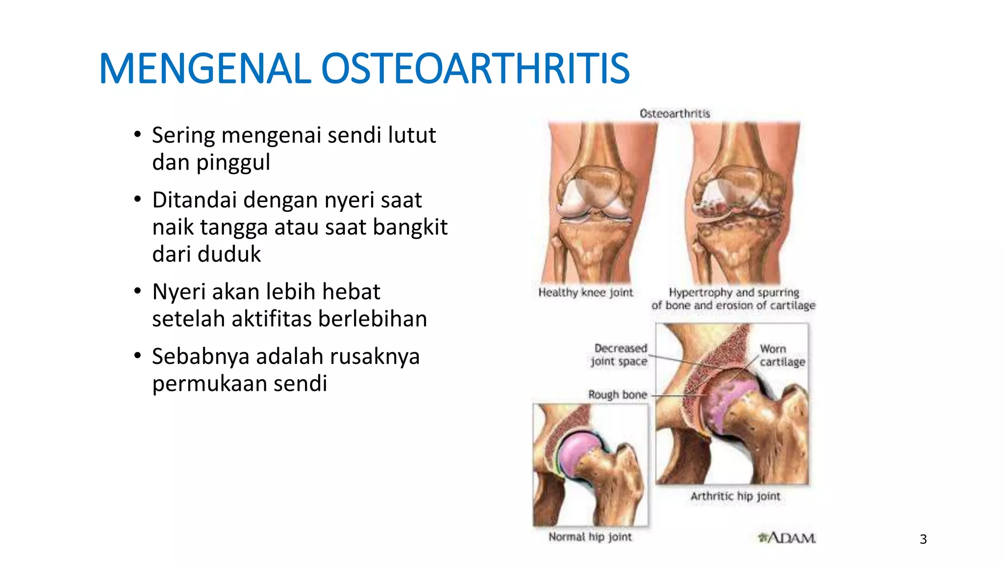 OSTEOARTHRITIS.pptx