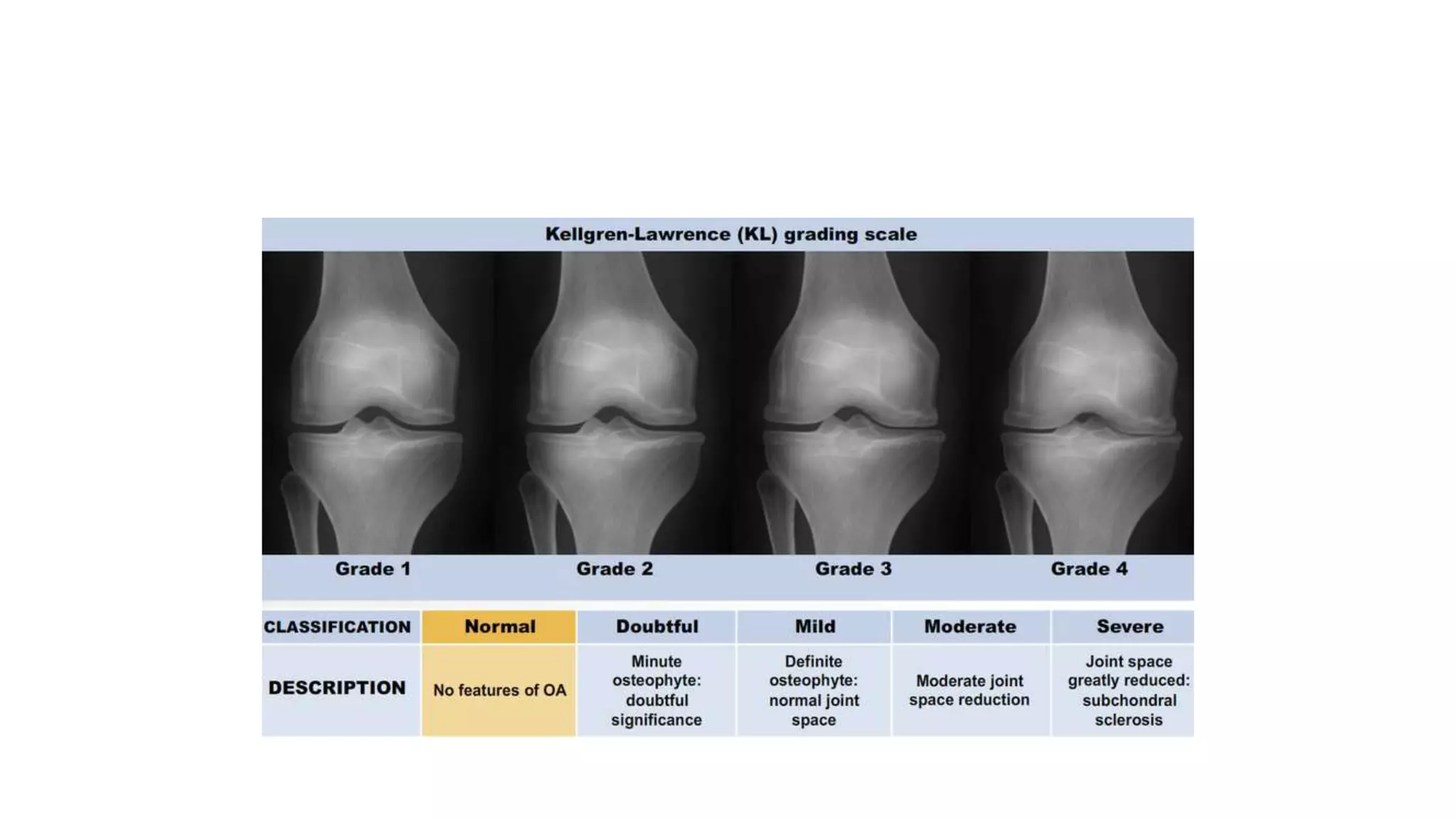 OSTEOARTHRITIS.pptx