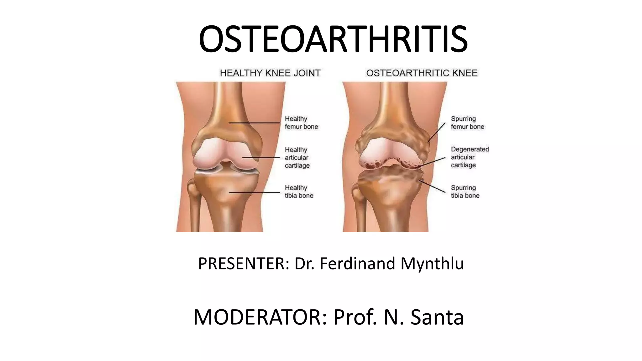 OSTEOARTHRITIS.pptx